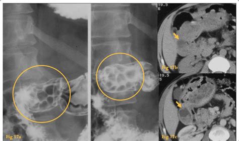 Juvenile Polyposis Ugis A With Multiple Filling Defects At The Download Scientific Diagram