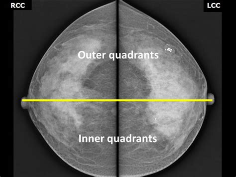 Atlas Of Breast Cancer Early Detection