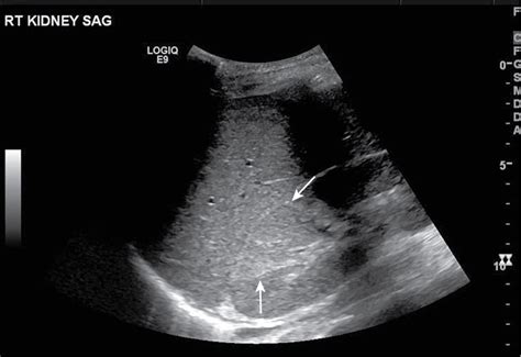 Renal Parenchymal Disease