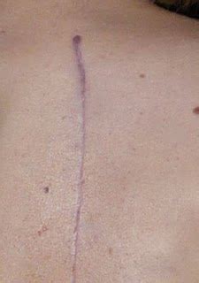My Scoliosis Scar Two Years Post Op Life With Scoliosis