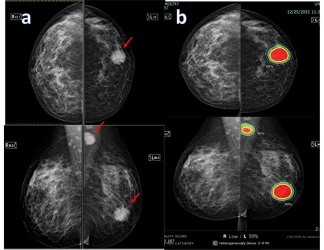 A 34 Year Old Female Patient Came With The Left Breast Lump A Digital