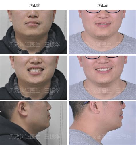 告别地包天笑容原来可以如此自信 贝致案例库 贝致专业口腔服务平台权威医生真实案例一次看够