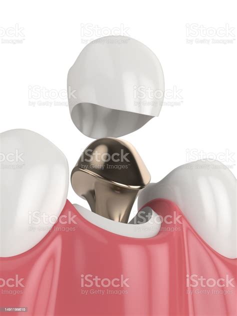캐스트 포스트 및 코어 치아 복원이 있는 아래턱의 3d 렌더링 1위에 대한 스톡 사진 및 기타 이미지 1위 3차원 형태 건강관리와 의술 Istock