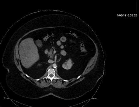 CT With IV Contrast Taken At Which Shows Ill Defined Hypoenhanced Download Scientific