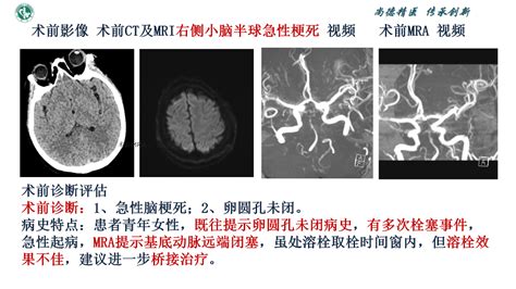 经桡动脉入路 基底动脉、大脑中动脉取栓技术荟萃（双蛇技术、 6fneuron™ Max长鞘应用 脑医汇