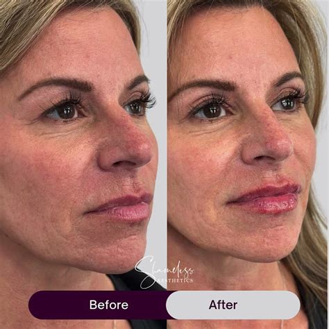 Enhanced And Redefined Lips Restored Youthful Volume And Symmetry For A Natural Luscious Pout