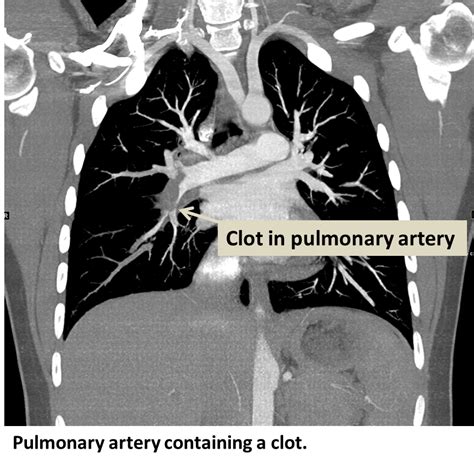 Pulmonary Embolism Pe Interventional Radiology Ucla Health