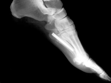 Acutrak Headless Compression Screw System Medhold Medical