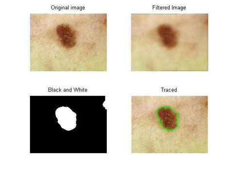 Skin Lesion Boundary Tracing Algorithm Do It Easy With Scienceprog