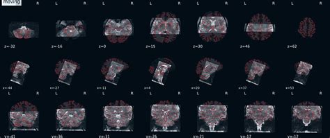 can fmriprep handle partial brain slabs for functional data software support neurostars