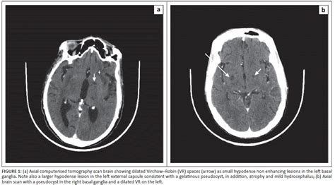 Computerised Tomography Findings In Hiv Associated Cryptococcal Meningoencephalitis At A