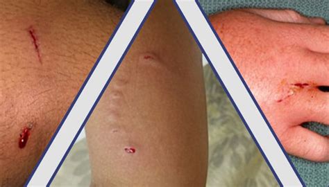 Bat Bite Mark