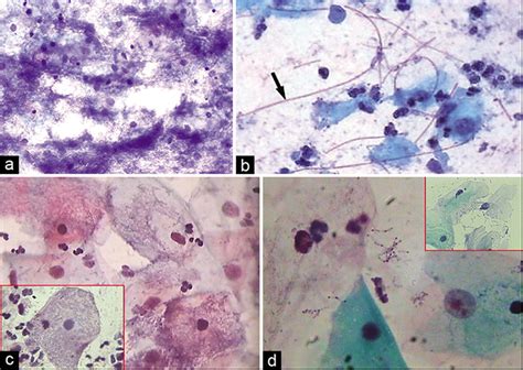 The Pap Smear In Inflammation And Repair Cytojournal