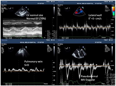 Evaluation Of Left Ventricular Diastolic Function By Echocardiography Intechopen Evaluation Of Left Ventricular Diastolic Function By Echocardiography Intechopen