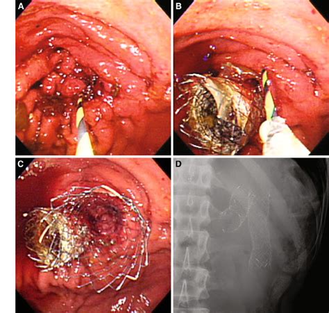 Malignant Gastrojejunal Anastomotic Obstruction A Before Sems