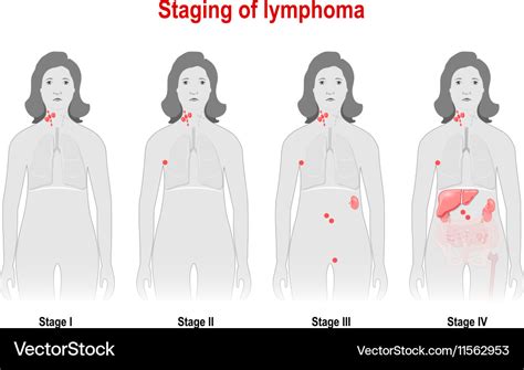 Staging Non Hodgkin Lymphoma Non Hodgkin Lymphoma Stages Okzaa