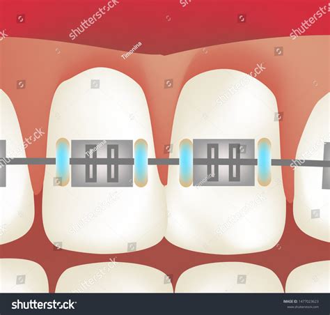 Structure Braces Orthodontics Infographics Vector Illustration