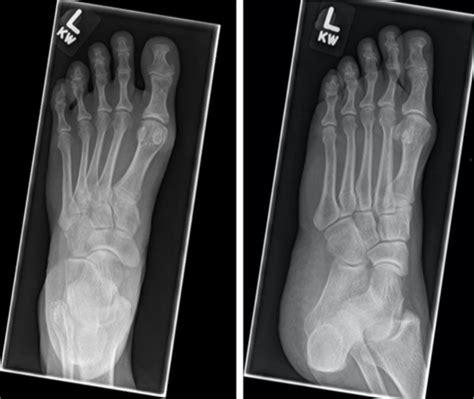 Osteochondroma Of The Tibial Sesamoid A Case Report And Osteochondroma