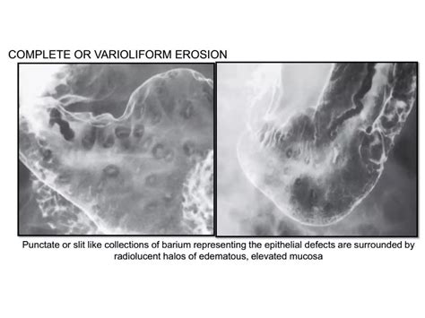 Fluoroscopic Imaging Anatomy And Pathology Of Stomach And Duodenum