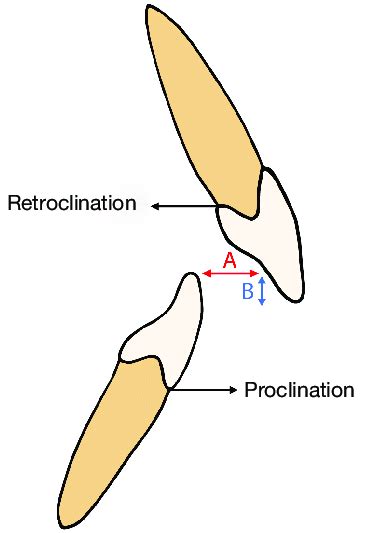 Diagrammatic Representation Of Potential Incisal Side Effects Upper Download Scientific