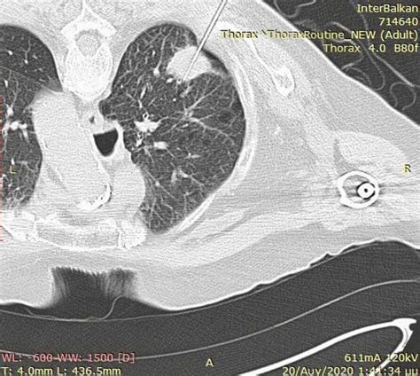 Εμφύτευση σήμανσης σε όγκο Fiducials Markers ΔρΤιτόπουλος