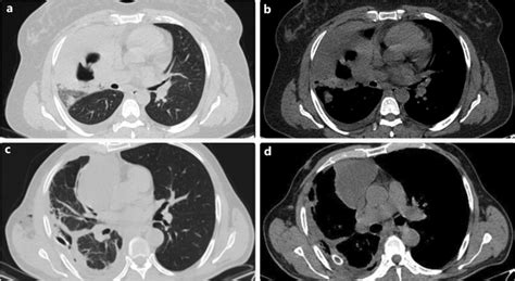 Thoracic CT Images Of Two Different Patients Who Were Followed Up With Download Scientific