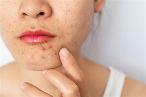 The 4 Best Ways To Treat Hormonal Acne According To A Dermatologist