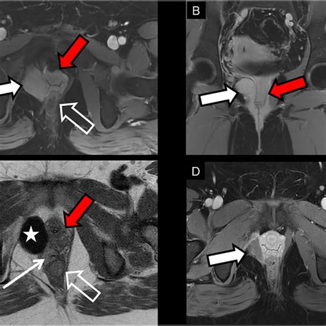 27 Yo Female Presents With A Recurrent Desmoid Tumor Adjacent To Vagina Download Scientific