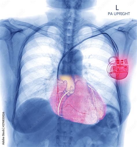 Chest X Ray Or X Ray Image Of Human Chest With Pacemaker Placement Or Cardiac Pacemakers For