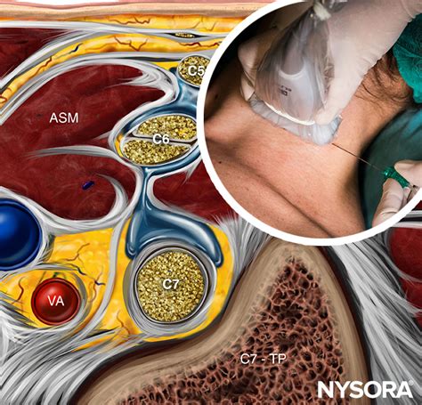 Ultrasound Guided Interscalene Brachial Plexus Nerve Block Nysora
