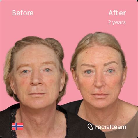 Nose Feminization Surgery With REVONose Facialteam