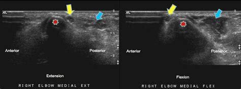 Ulnar Nerve Dislocation Associated With A Low Lying Medial Triceps Download Scientific Diagram