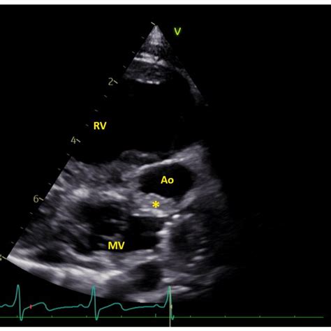A Short Axis View Showing The Thrombus In Native Aorta Ao B