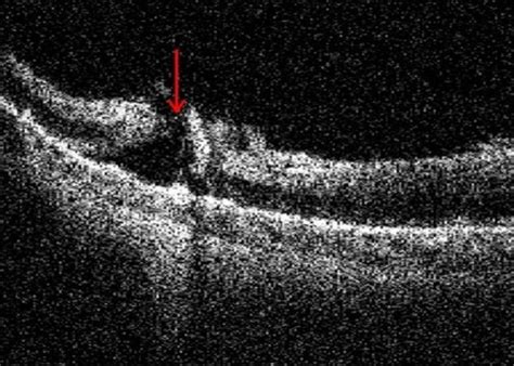 B Scan From Intraoperative Swept Source Microscope Integrated Oct Shows