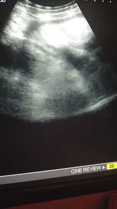 ولد ولا بنت نصف الثامن 😍سونار نوعالجنين Shorts Youtube