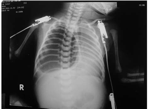 Pulmonary Cysts On X Ray Vinmec