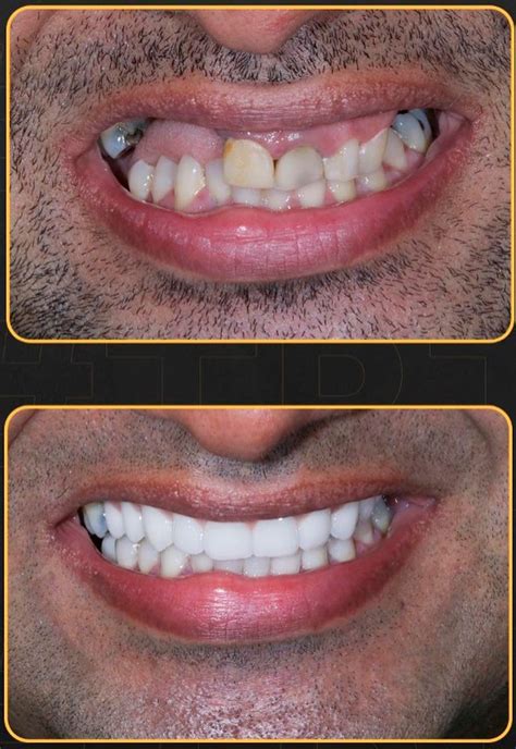 Protocolo Fixo Sobre Implantes