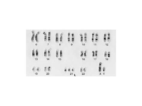 Chromosome Karyotype And Numerical Chromosomal Abnormalities Dr