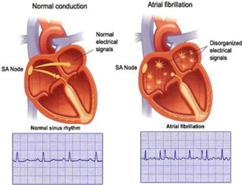 Paroxysmal Atrial Fibrillation