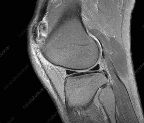 Normal Mri Knee