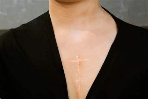Open Heart Surgery Scar Healing How To Care Scars Miami Fl