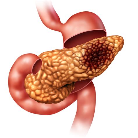 Doctors Discover Why Pancreatic Cancer Kills So Quickly American