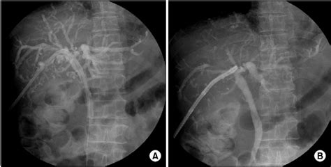 Cholangiography Findings A Percutaneous Transhepatic Biliary Drainage Download Scientific