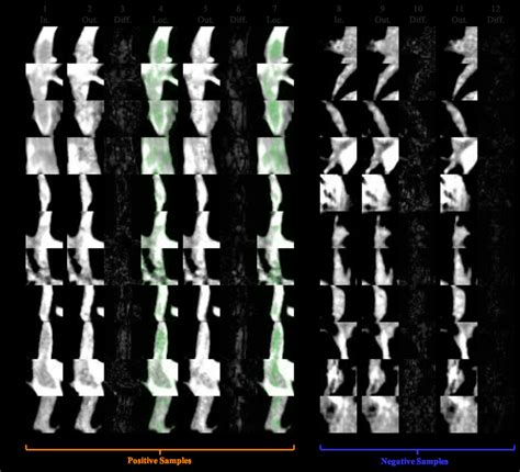 Continued From Fig 2 Pulmonary Embolism Pe Detection And Download Scientific Diagram