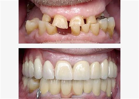 Oral Rehabilitation Impact Factor Nzqpb