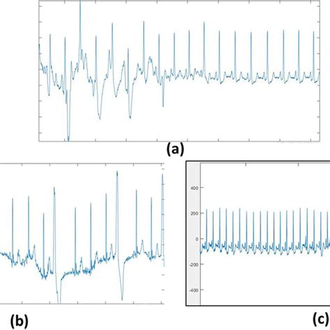 A Unfiltered Ecg Signal With Noisy Peaks In Record 105 Of Mit