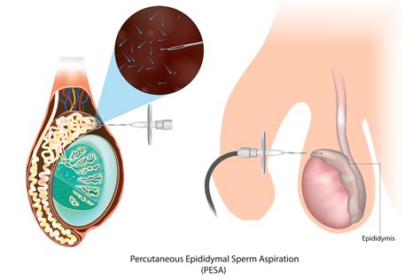 Percutaneous Epididymal Sperm Aspiration Pesa