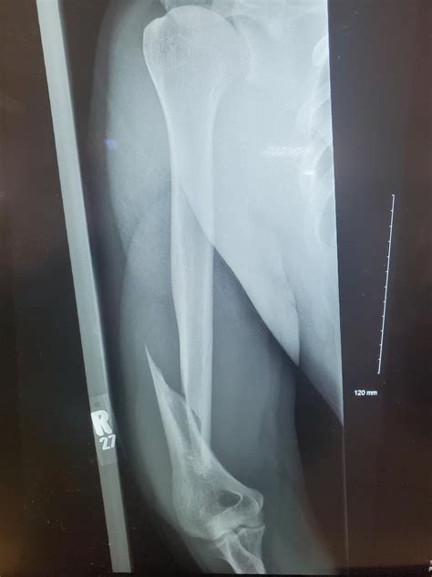 Distal Humerus Fracture 20wk Post Orif Surgery R Brokenbones