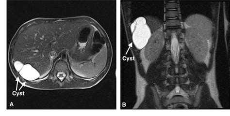 Figure 1 From Laparoscopic Excision Of A Ciliated Hepatic Foregut Cyst