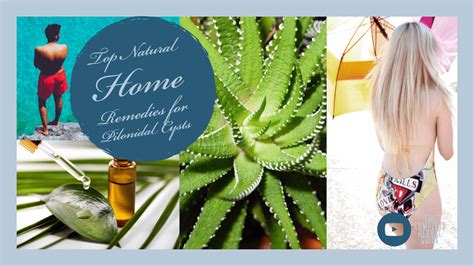 Top Natural Home Remedies For Pilonidal Cysts The Advisor With Stacey